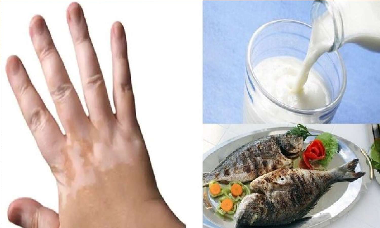 क्या मछली खाने के बाद दूध पीने से स्किन में सफ़ेद दाग पड़ जाते हैं?